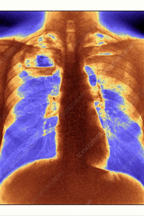 Wegeners Disease X Ray Stock Image C0448834 Science Photo Library