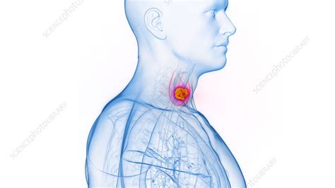 Thyroid Cancer Illustration Stock Image F0380381 Science Photo Library