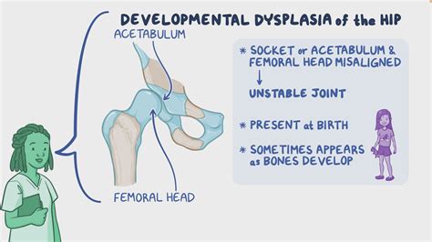Video Developmental Dysplasia Of The Hip Nursing Osmosis