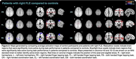 Motor Reorganization In Frontal Lobe Epilepsy
