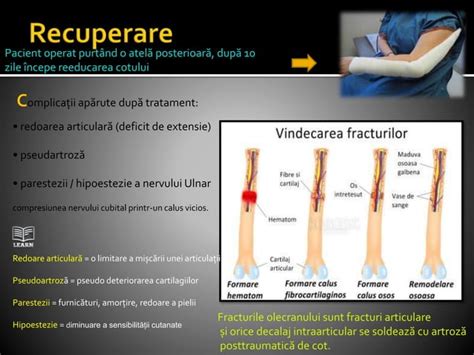 Fractura De Olecran Pptx