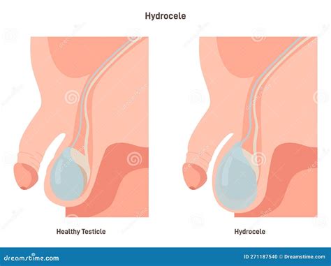 Hydrocele Swelling In The Scrotum Stock Vector Illustration Of Fluid Artery 271187540