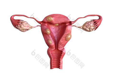 子宫肌瘤是由肌肉组织形成的良性实体肿瘤其图片 包图网企业站