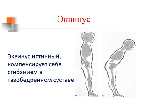 Церебральный паралич Online Presentation