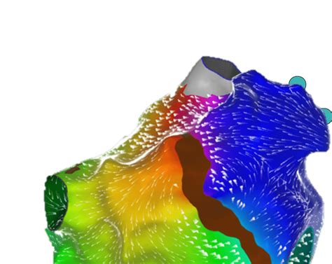 Atrial Flutter Ablation At Drkarthigesan Clinic Chennai Atrial Flutter Ablation At Drkarthigesan Clinic Chennai