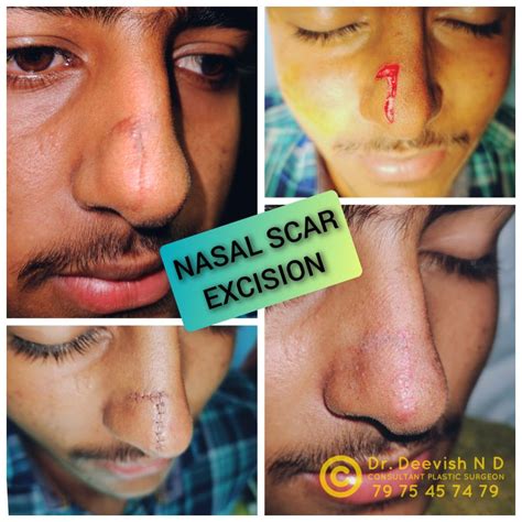 Deevish Dinakara On Linkedin Scarexcision Facialscar Nosescar Drdeevishnd Plasticsurgery…