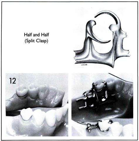 Removable Partial Denture Clasp Types At Rose Perez Blog