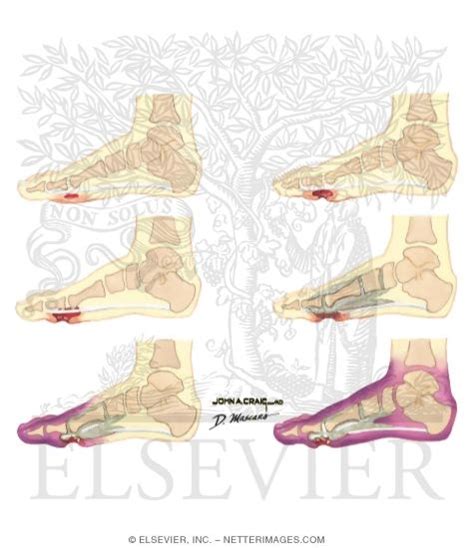 Diabetic Foot Ulcer Wagner Classification