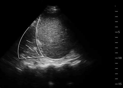 Lung Ultrasound A Practical Review For Radiologists Applied Radiology