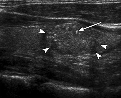 갑상선 결절 Overview Of Thyroid Nodule 네이버 블로그