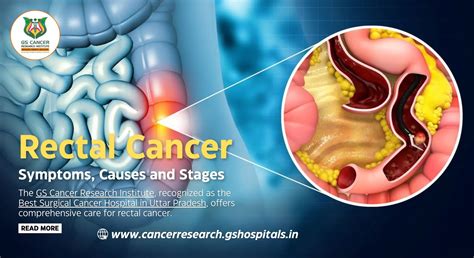 Rectal Cancer Symptoms Causes And Stages