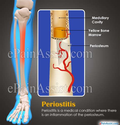 Periostitiscausessymptomstreatmentrehabprognosis