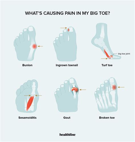 Why Do The Bottom Of My Toes Hurt At Peggy Jackson Blog