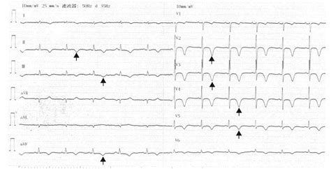 Inverted T Waves Arrows In Leads I Ii Iii Avf And V1 6 In Case 1 Download Scientific