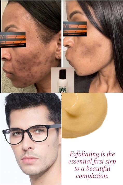 The Truth Behind Brown Spots On Face Artofit