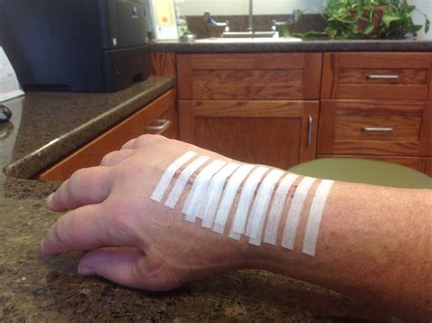 A Definitive Guide To Carpectomy V Maga