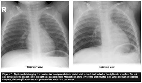 Miscellaneous Aspirated Foreign Body X Ray Findings Air