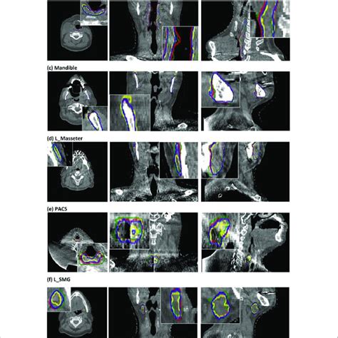 Segmentation Examples In Axial Frontal And Sagittal Views Are Manual