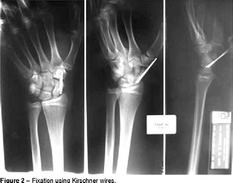 Structure Of Scaphoid Tubercle Semantic Scholar