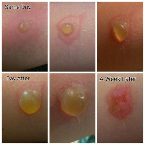 Stages Of Burn Healing For 2nd Degree Burn