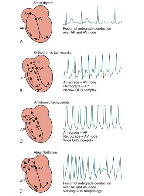 The Heart 🔴wolff Parkinson White Wpw Syndrome Understanding The Rhythm Patterns⤵️ 🔹wpw Is