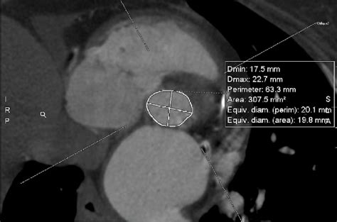 Annulus Measurements For Valve Sizing With An Annular Area Of 308 Mm 2