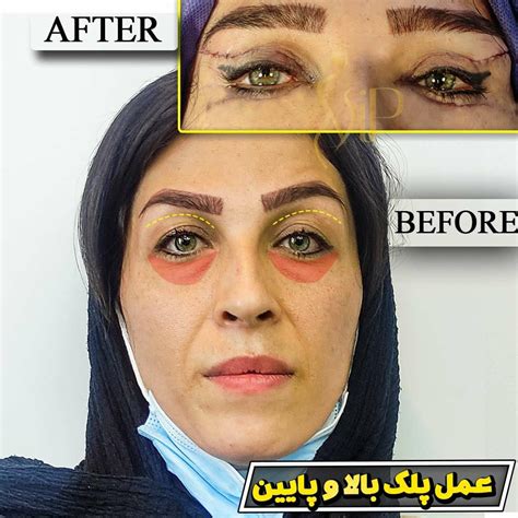 عکس قبل و بعد از جراحی پلک کلینیک زیبایی Vip