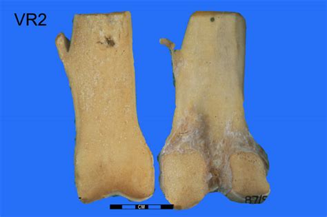 Osteochondroma Museum Of Pathology