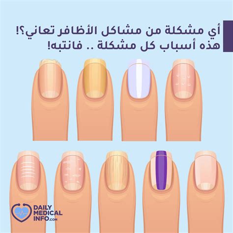 كل يوم معلومة طبية كلنا بلا استثناء عرضة لمشاكل الأظافر المختلفة مثل