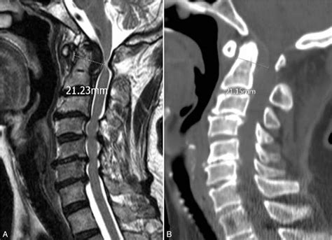 Postoperative Regression Of Retro Odontoid Pseudotumor After Spine