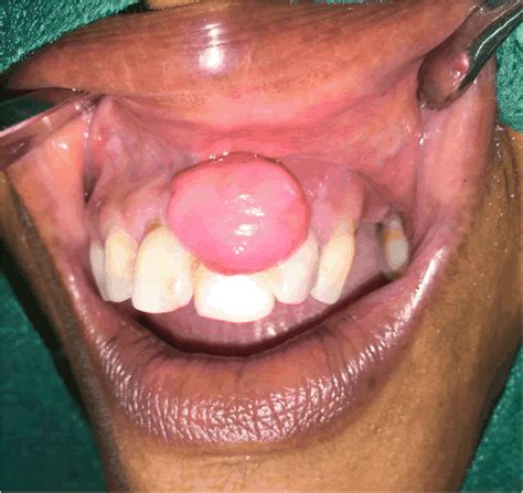 Identification Of A Peripheral Ossifying Fibroma Download Scientific Diagram