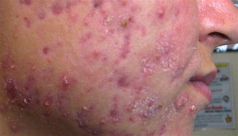 5 Skin Problems You Might Face Due To Vitamin D Deficiency