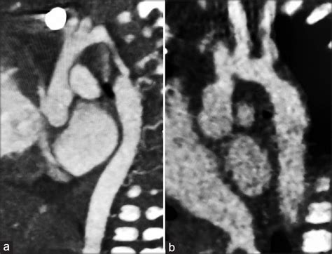 Coarctation Of The Aorta With Aortic Arch Hypoplasia Midterm Outcomes Of Aortic Arch