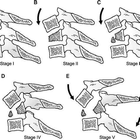 Bursting Fracture Of T1 And C7 T1 Unilateral Facet Joint Dislocation Download Scientific