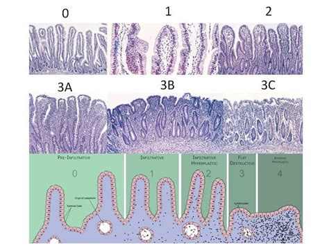 Virchows Eye Marsh Classification Celiac Disease