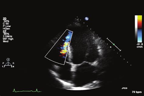 Two Dimensional Transthoracic Color Flow Doppler Echocardiogram Shows