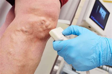 Venous Reflux Venous Insufficiency Vein Clinic Perth