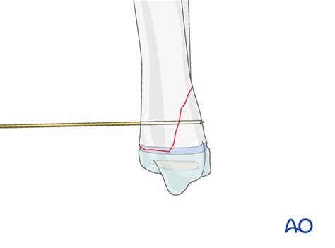 Open Reduction Screw Fixation For Epiphysiolysis With Metaphyseal Wedge Salter Harris Ii Of