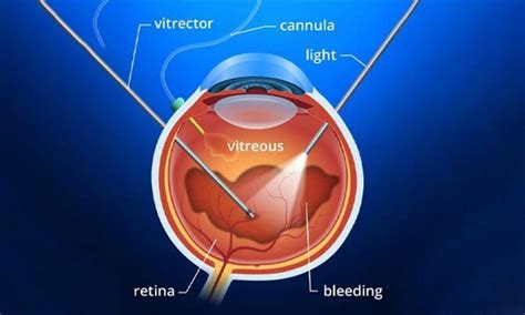 Vitrectomy Steady Growth New Technologies Will Drive Retinal Surgery