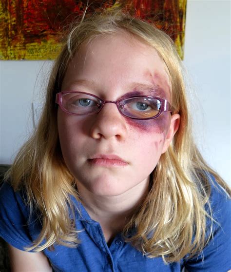 Bruised Eye Socket Bruise Wheels Black Eyes And Totally Disgusting