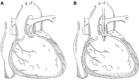 法洛四联症的修复：如何进行手术？ 知乎
