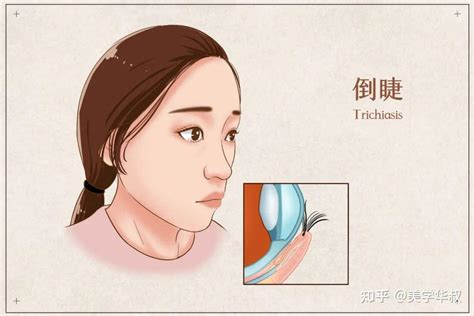 为什么医生不建议你做夸张的眼睑下至？一味追求大眼可能后患无穷 知乎