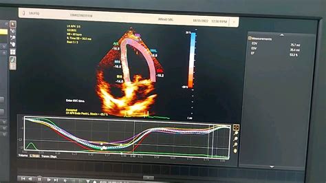 Asif Mohammad On Linkedin Automated Cardiac Motion Quantification Acmq