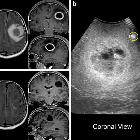 A Preoperative Axial Sagittal T1 Weighted Post Contrast And