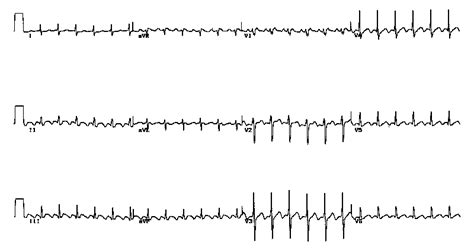 Atrial Flutter With 2 1 Atrioventricular Conduction