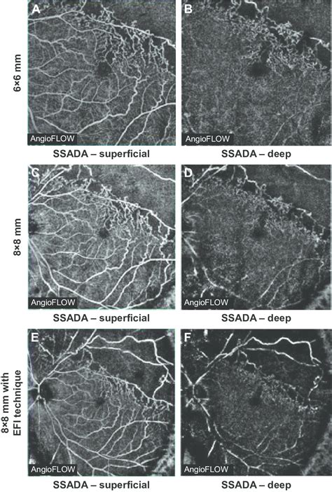 Comparison Of Image Resolution Between Scan Size And Retinal Capillary Download Scientific