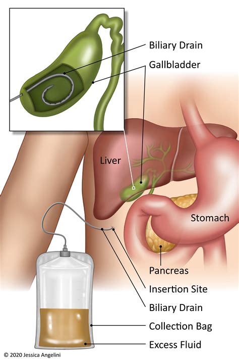 Biliary Drain Oncolink