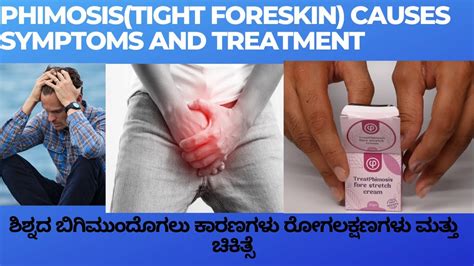 PHIMOSIS TIGHT FORESKIN ಶಶನದ ಬಗಮದಗಲ CAUSES SYMPTOMS
