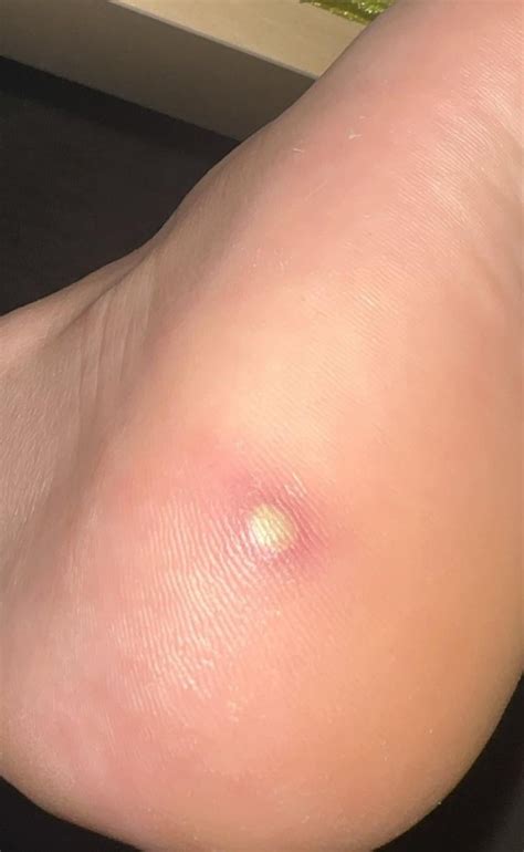 Painful Bump On Inside Of Buttcheek At Isabella Embry Blog