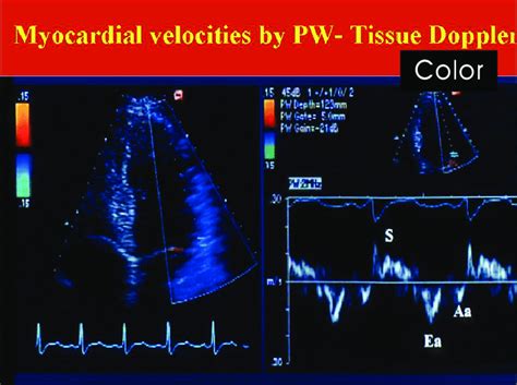 Tissue Doppler Signals From The Lateral Side Of The Mitral Annulus S
